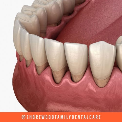 Gum Recession: Causes & Treatments | Dentist Near Joliet, IL