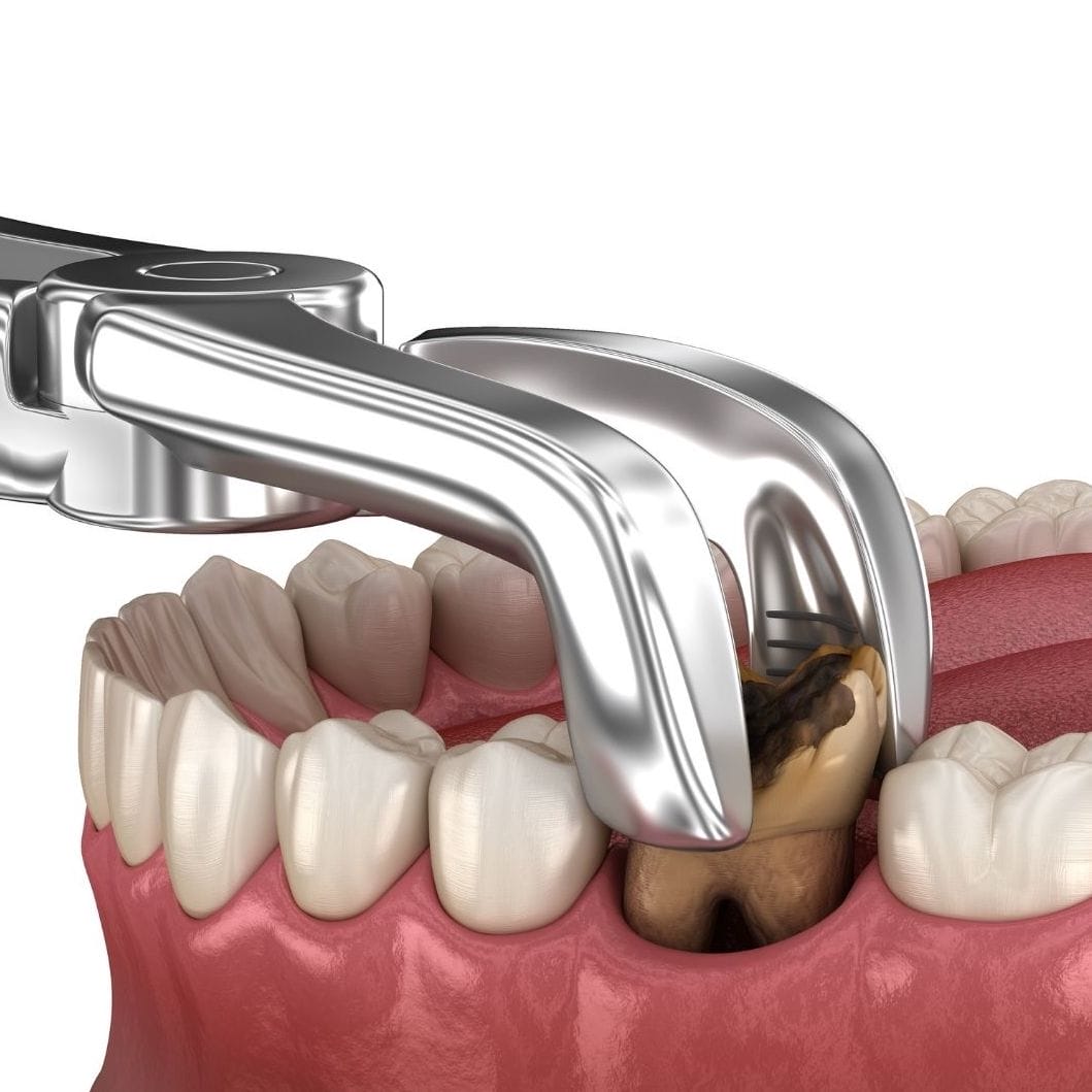 Dead Tooth: What It Is & Its Oral Health Impact | 815-725-5991